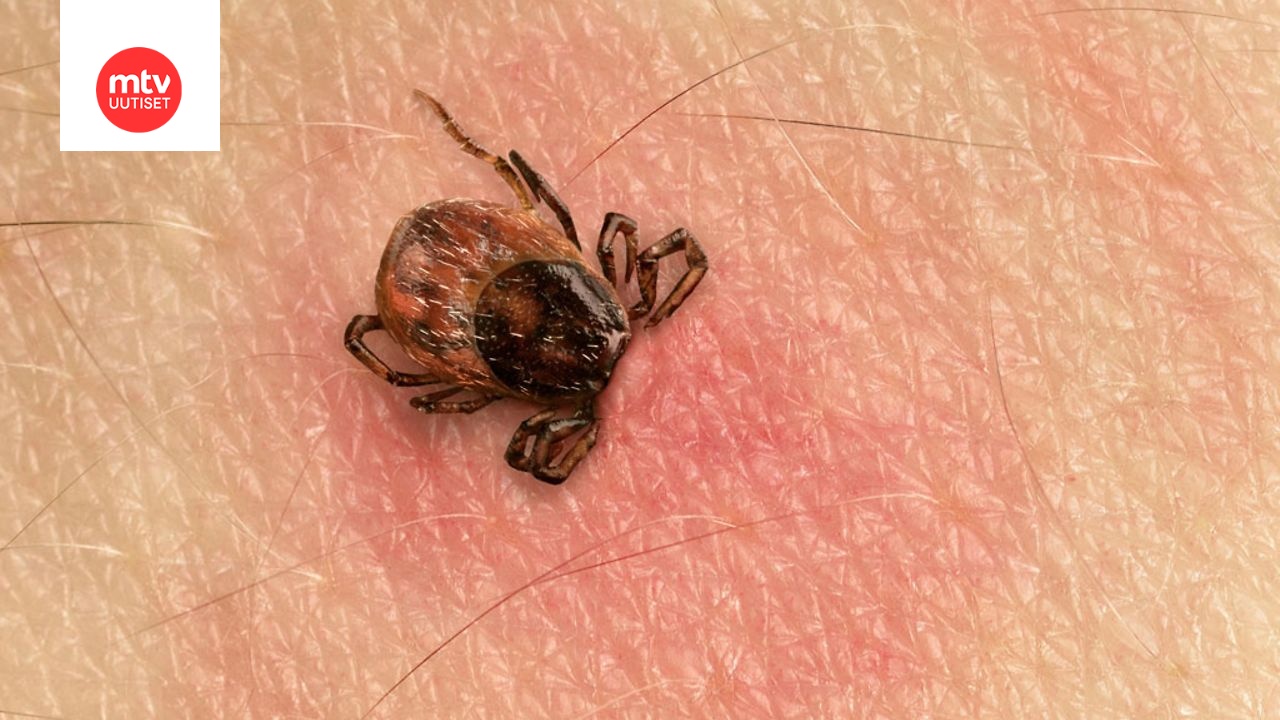 Puriko punkki? Tunnista borrelioosin oireet - MTVuutiset.fi