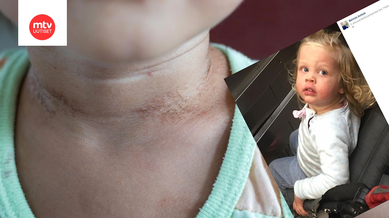 Ihottuma kasvoilla oli liikaa – lentoyhtiö ei päästänyt taaperoa ...