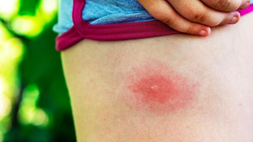 Nämä yhdeksän iho-oiretta voivat olla merkkejä vakavista sairauksista ...