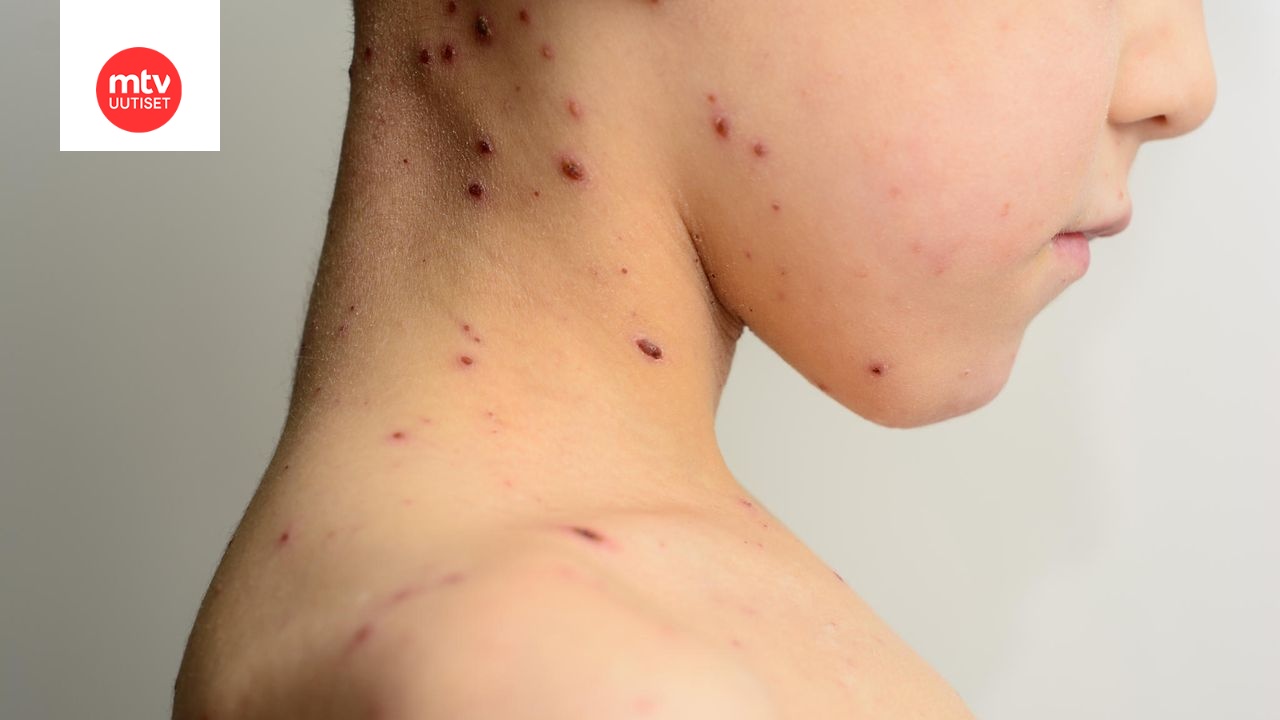 Louise sairasti vesirokon 5-vuotiaana – yli 25 vuotta myöhemmin arvesta ...