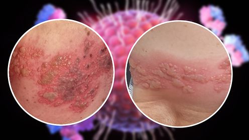 Mikä on vyöruusu? Oireet, hoito ja ehkäisy - MTVuutiset.fi