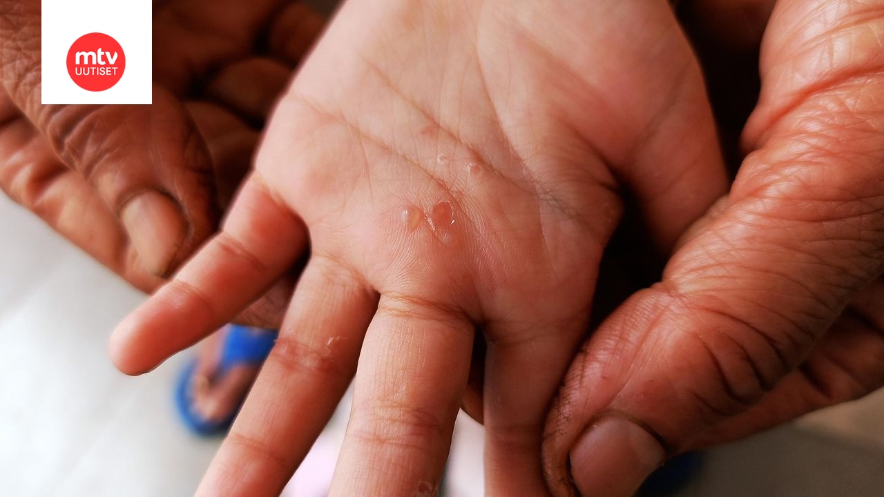 Syyhy leviää räjähdysmaisesti - MTVuutiset.fi