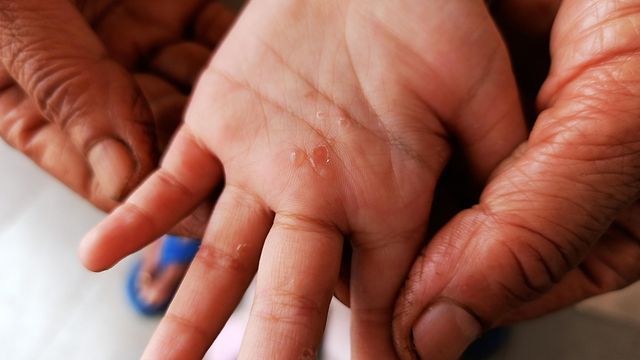 Ihotautilääkäri kertoo, mistä syyhyn leviäminen johtuu – tunnista oireet - MTVuutiset.fi