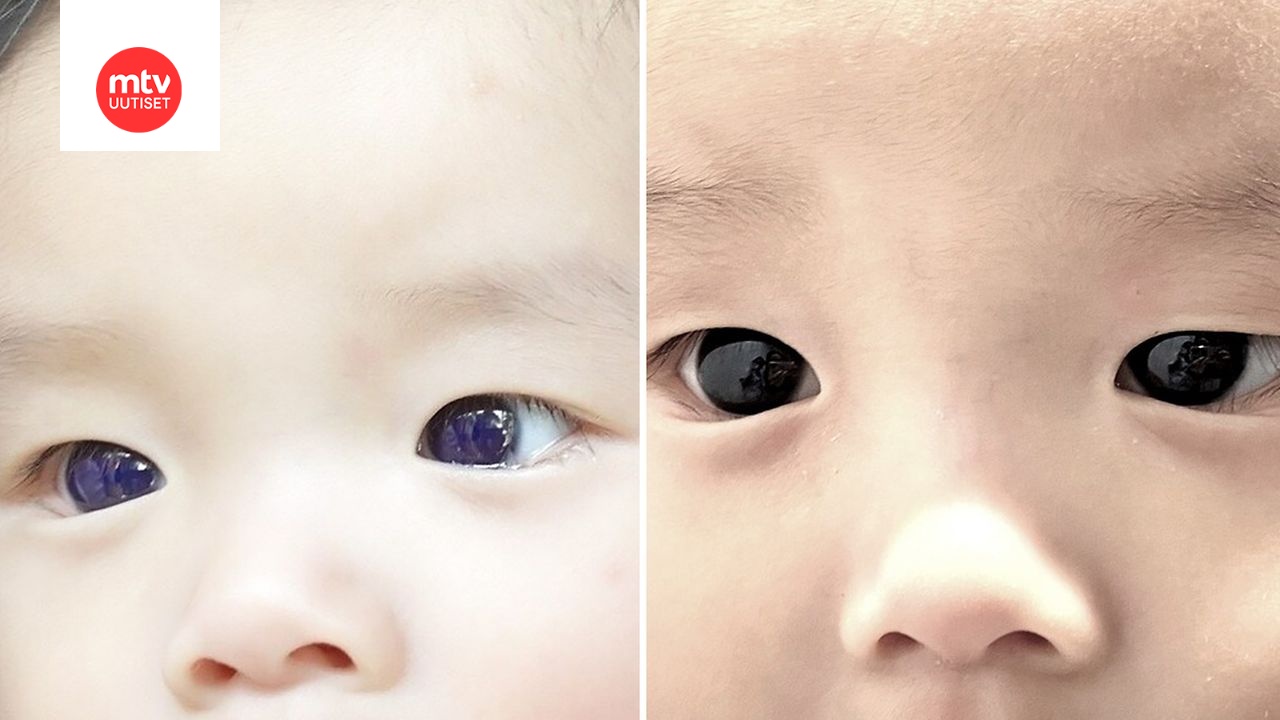 Koronalääke muutti vauvan silmien väriä - MTVuutiset.fi