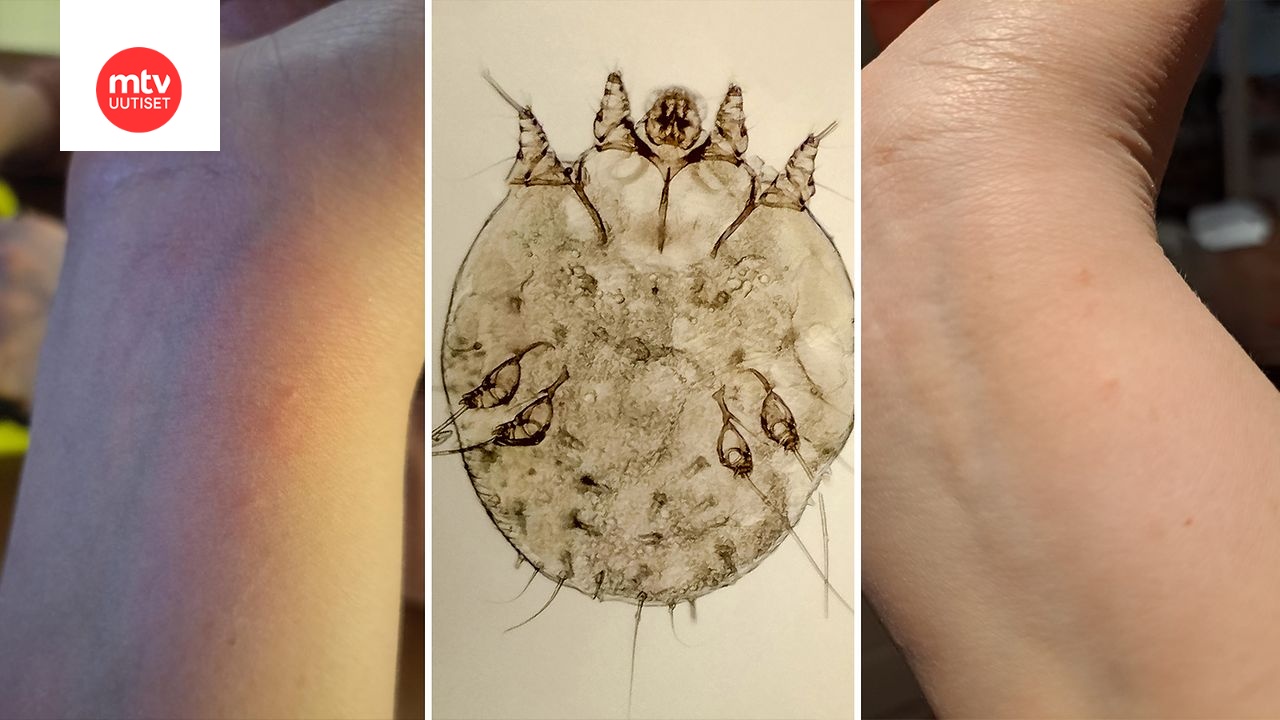 Näin pääset eroon syyhypunkista - MTVuutiset.fi