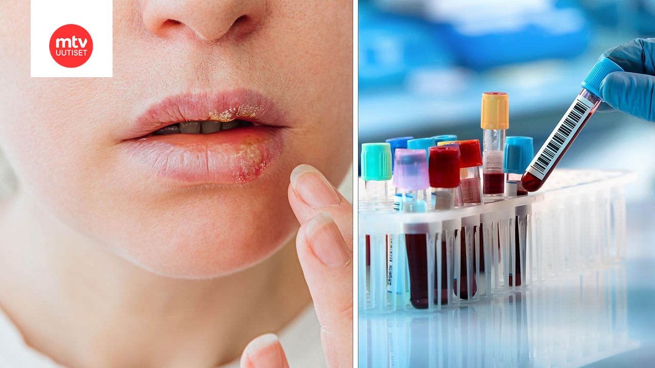 Onko genitaaliherpes sama asia kuin huuliherpes? - MTVuutiset.fi
