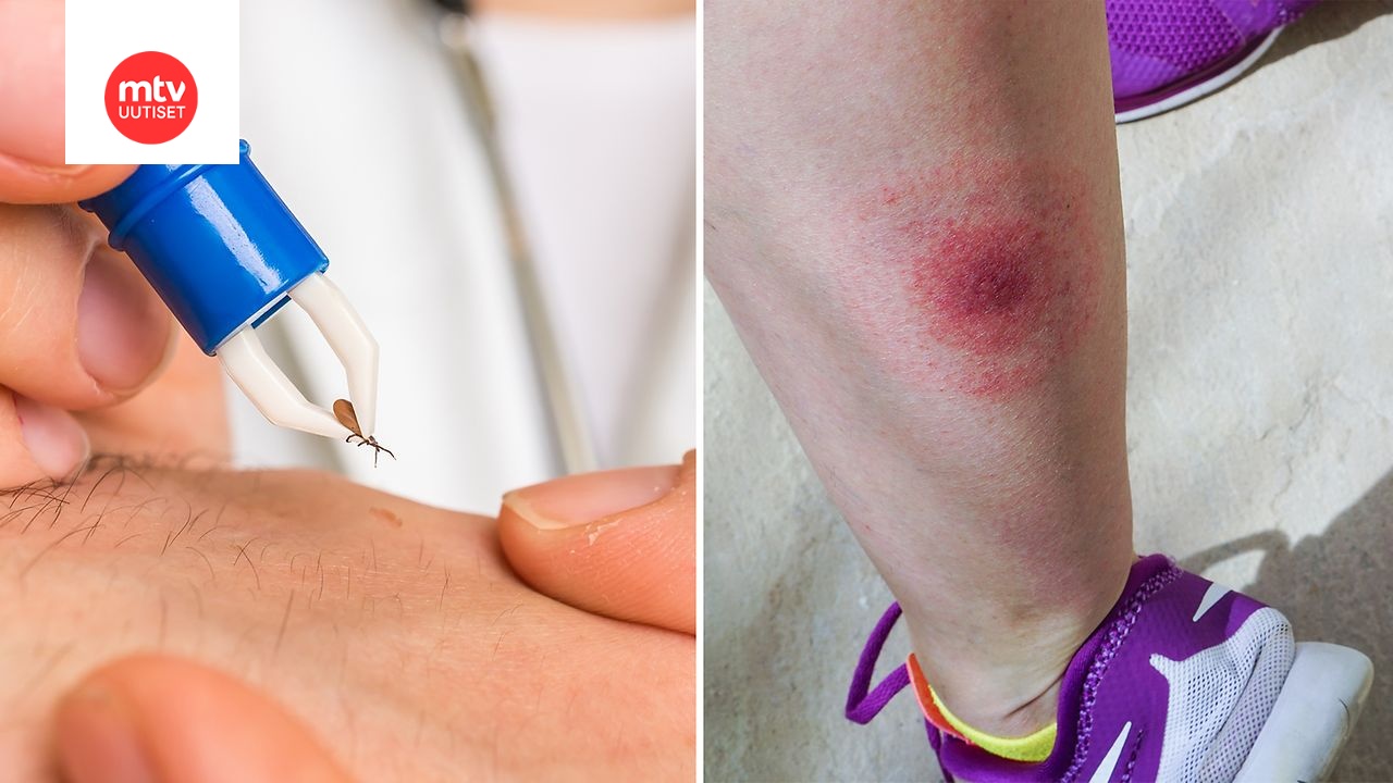 Kuinka todennäköisesti punkista saa borrelioosin? - MTVuutiset.fi