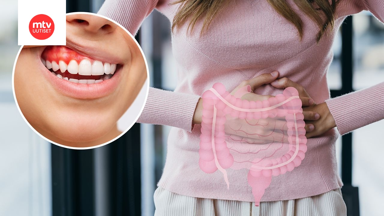 Yleinen suun bakteeri nopeuttaa syövän kasvua - MTVuutiset.fi