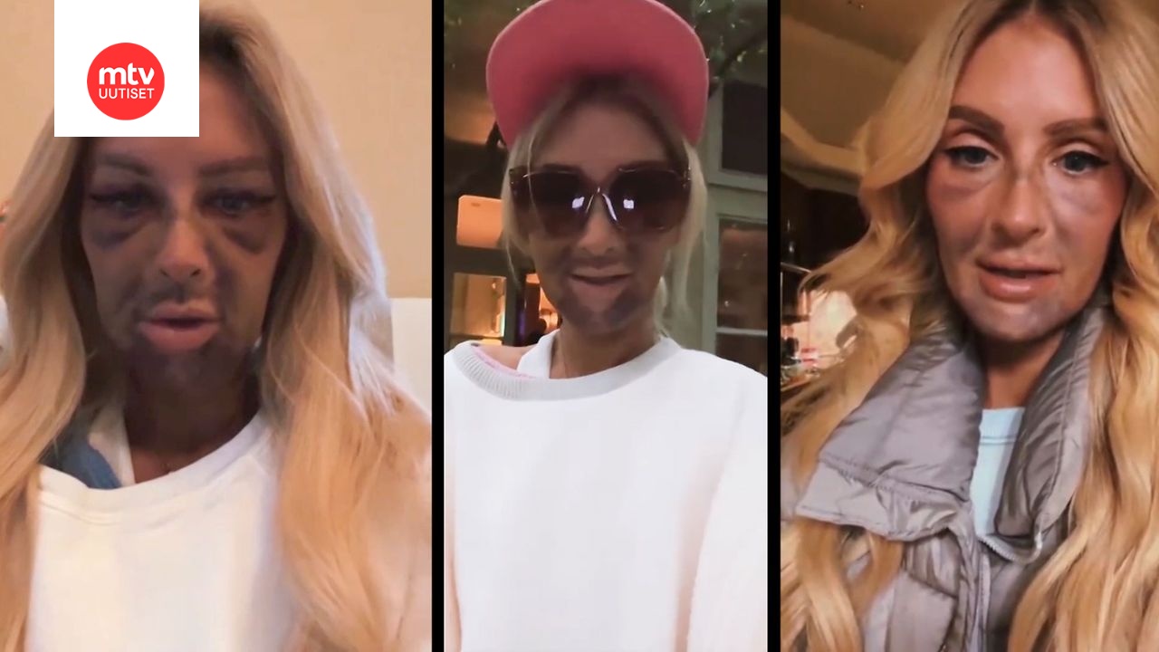 Jessican hammasimplantit johtivat karmivaan mustelmaan kasvoissa ...